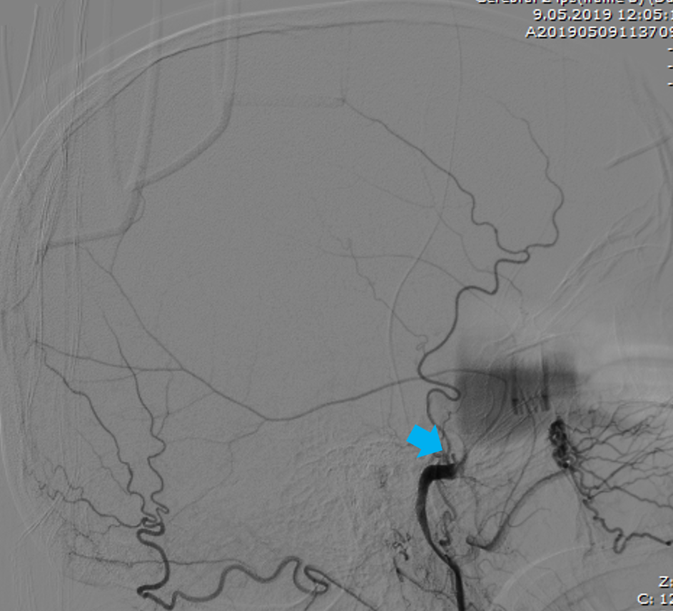 A Proximal Occlusion: One and Done - Vesalio