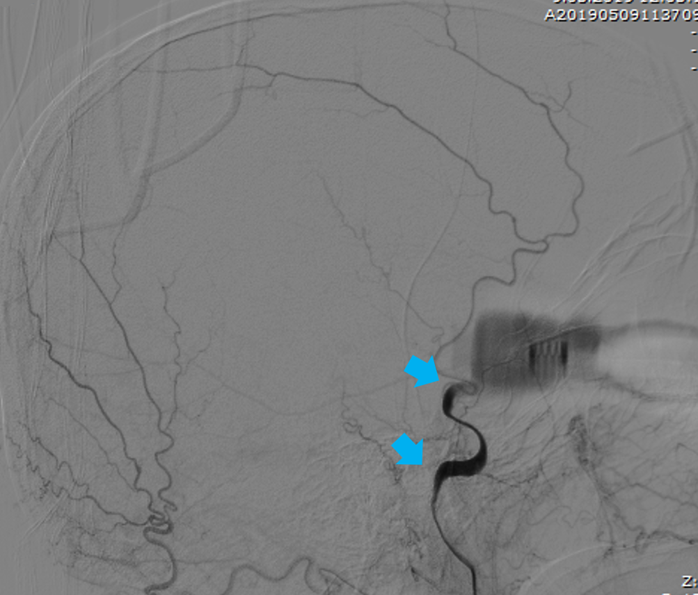 A Proximal Occlusion: One and Done - Vesalio
