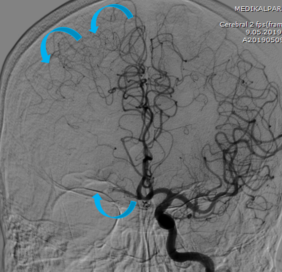 A Proximal Occlusion: One and Done - Vesalio