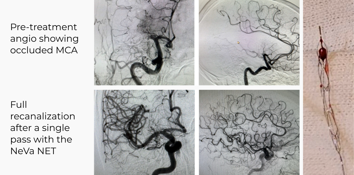 Vesalio | Treating Stroke And Vascular Occlusions